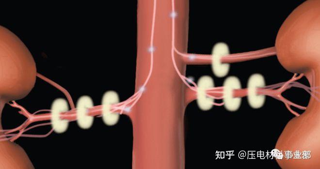 超声肾去神经（RDN）压电陶瓷圆管-超声消融导管 - 知乎