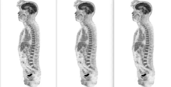 临床案例——RaDynMR、RaDynPET、RaDynCT、RaDynSPECT - 知乎