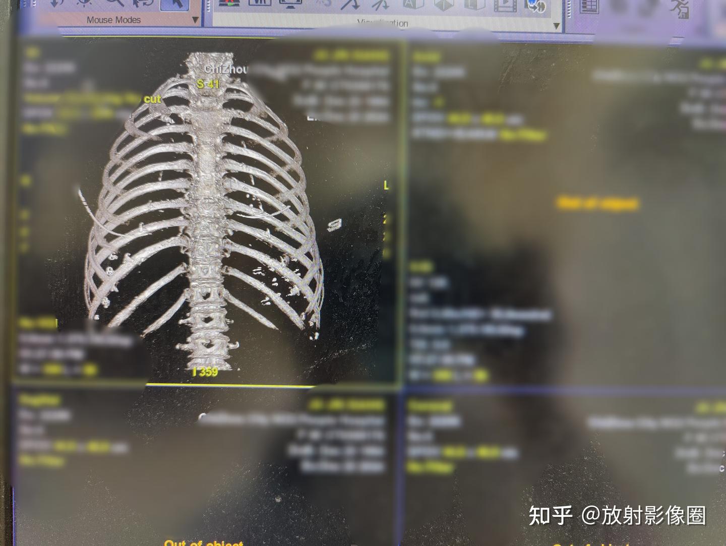 浅谈CT三维重建的操作方法 - 知乎