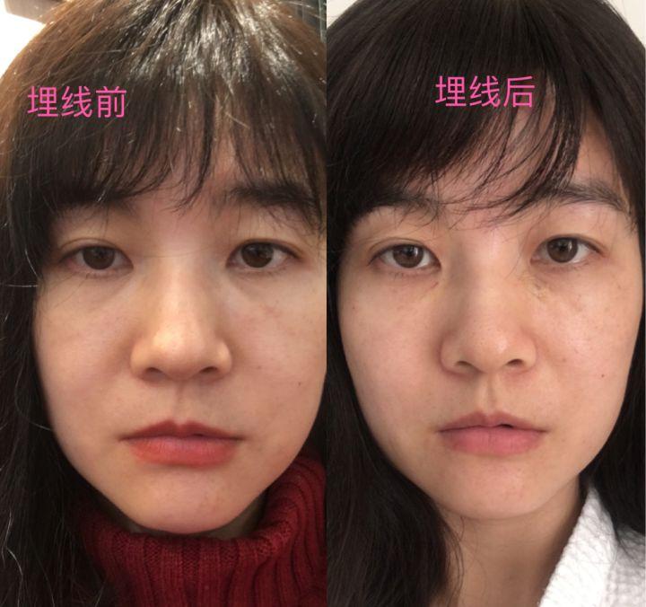 线雕的线PDO、PPDO、PLLA有啥区别？为什么这么多人想做线雕提升？ - 知乎