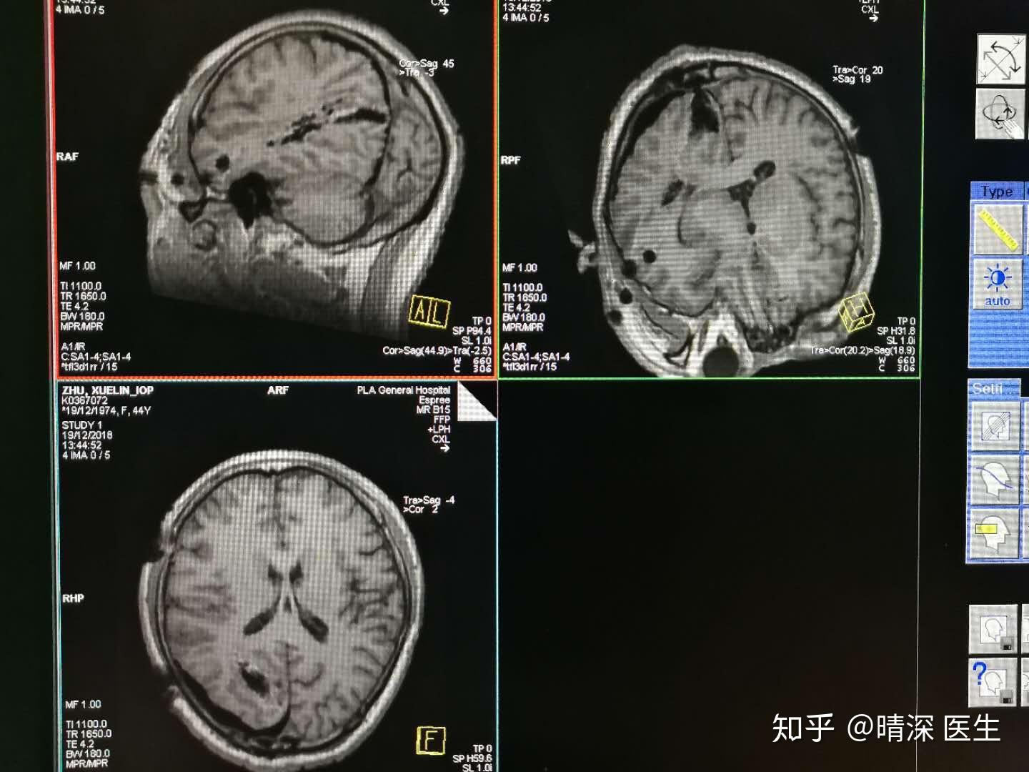 MRI,MRS,MRA是什么检查？ - 知乎