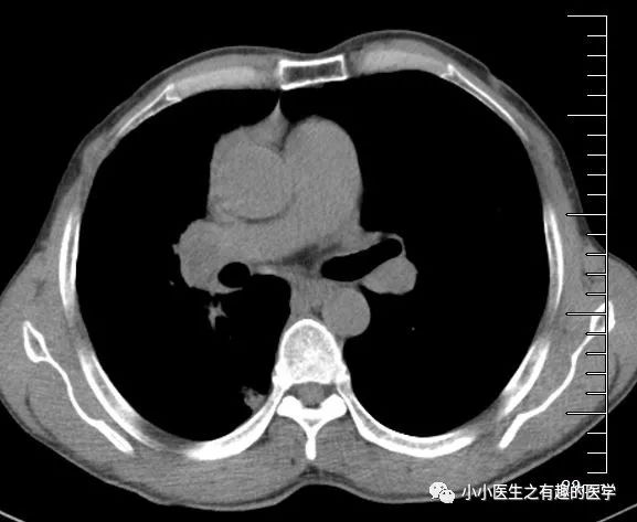 医院的普通ct,普通核磁共振和增强ct增强核磁到底是不是为了创收才让病友去做更贵的增强版？ - 知乎