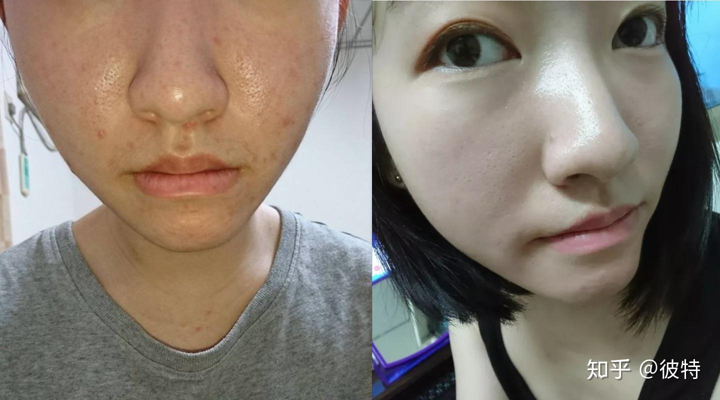 最有效的祛痘方法是什么？ 知乎