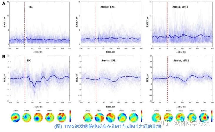 IF=7.8 | β振荡被抑：TMS-EEG揭示急性缺血性卒中后半球间功能失衡机制 - 知乎