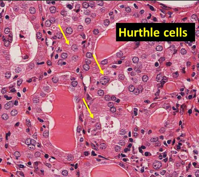 揭示Hurthle细胞癌的真相 - 知乎