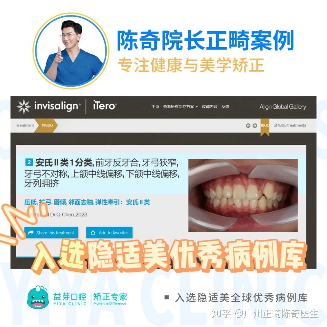入选Invisalign Global Gallery |青少年牙列拥挤+个别牙反颌，不拔牙矫正，17个月解锁健康咬合！ - 知乎