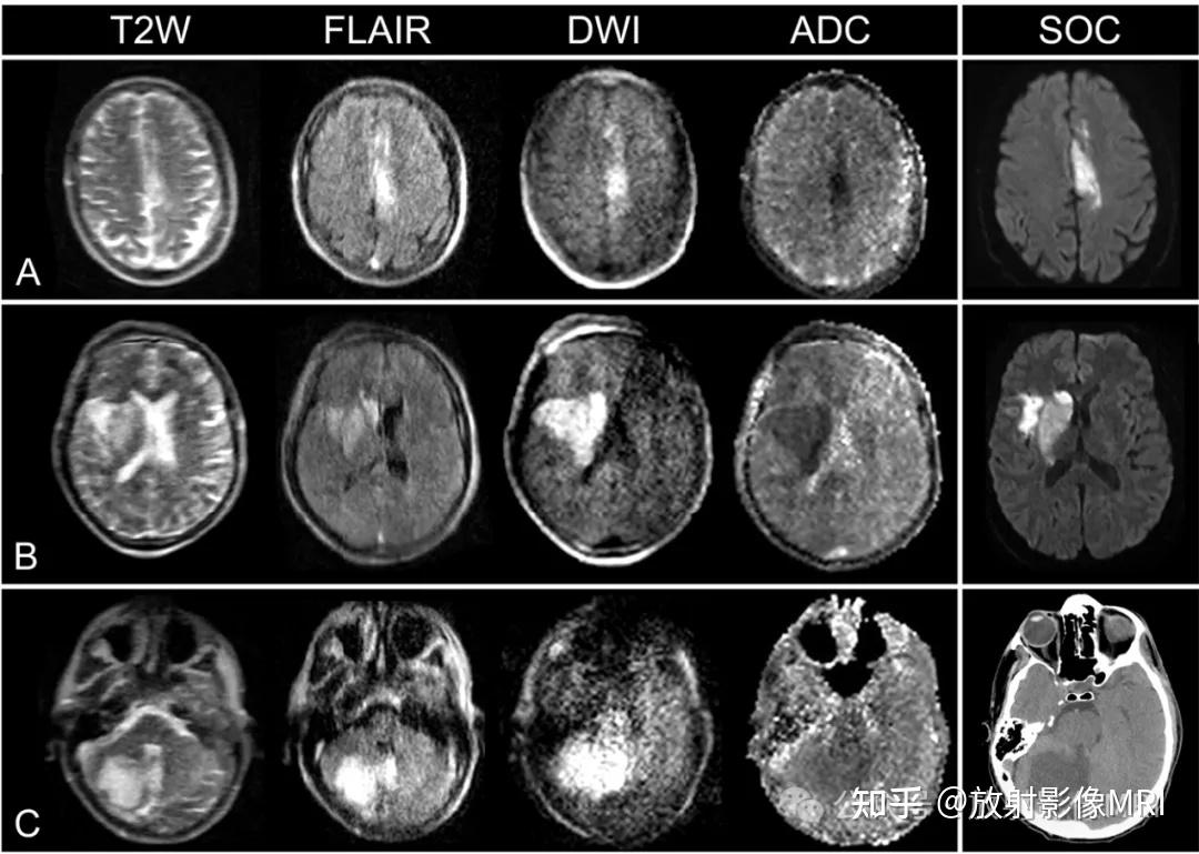 必看顶刊综述！7T磁共振、AI诊断、脑清道夫：一文读懂改变医学命运的神经影像十年 - 知乎