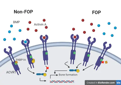 进行性骨化性纤维发育不良（FOP） - 知乎