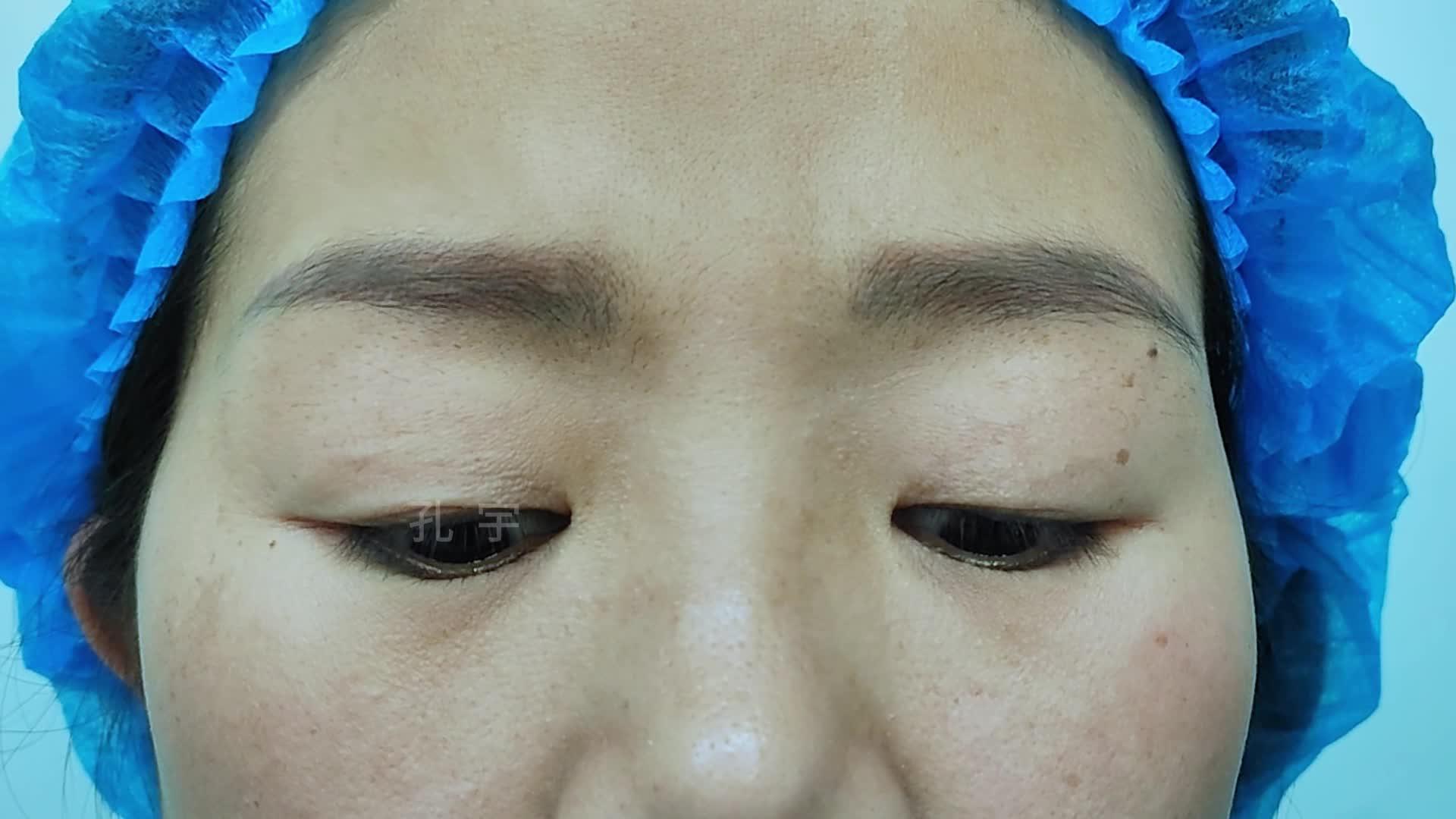 孔宇:上周学习班第一位模特 双眼先天性重度上睑下垂修复”反馈 知乎