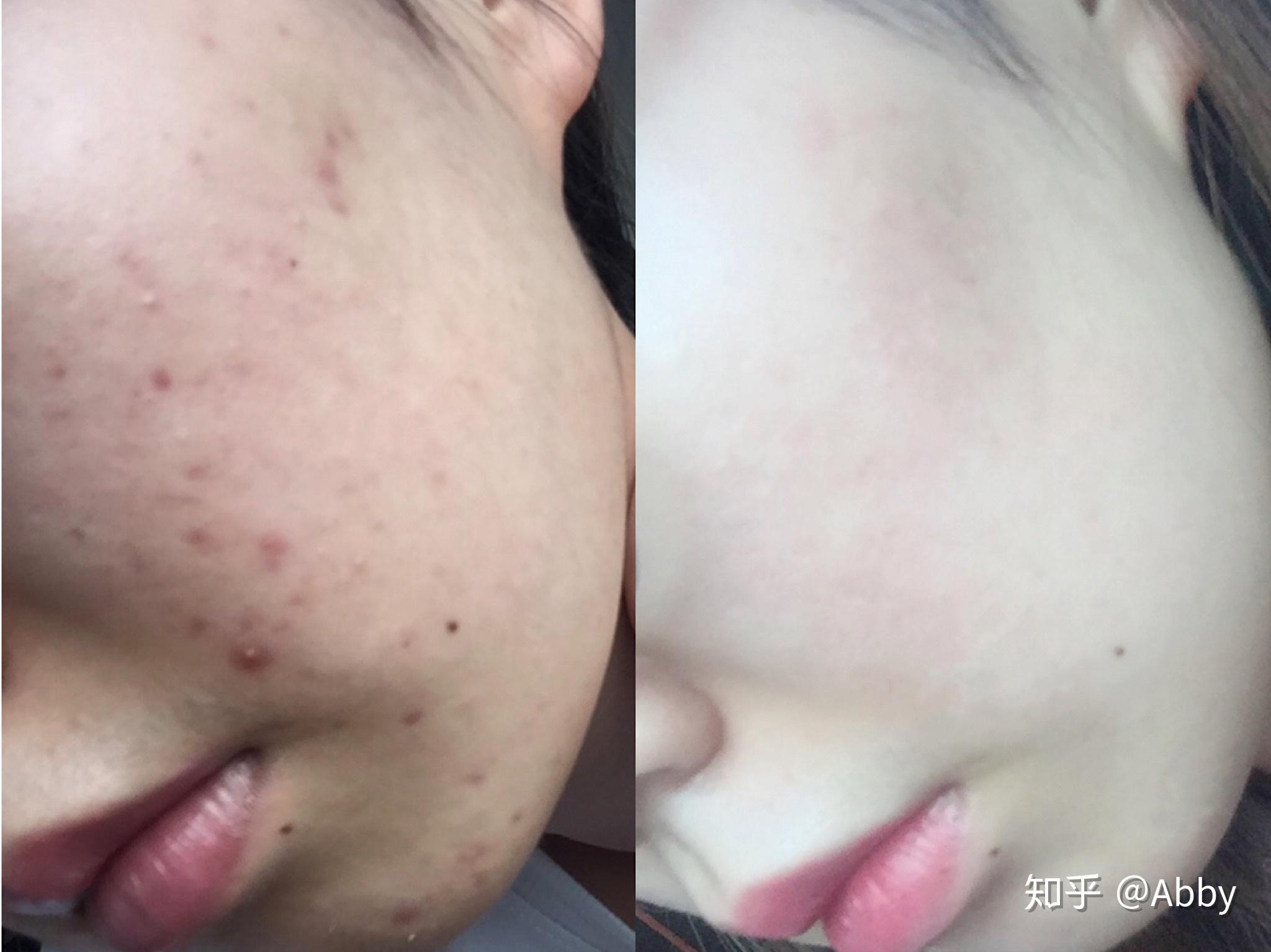 怎么才能消除脸上的痘印? 知乎