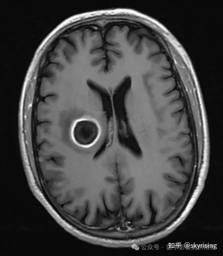 【MRS实战最终版】五例脑实质肿瘤或肿瘤性病变或良性病变MRS影像鉴别诊断并中英文报告模板范例 - 知乎
