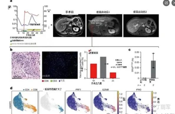 胰腺癌治疗新突破！mRNA疫苗+免疫疗法+化疗，创新组合疗法展现曙光 - 知乎