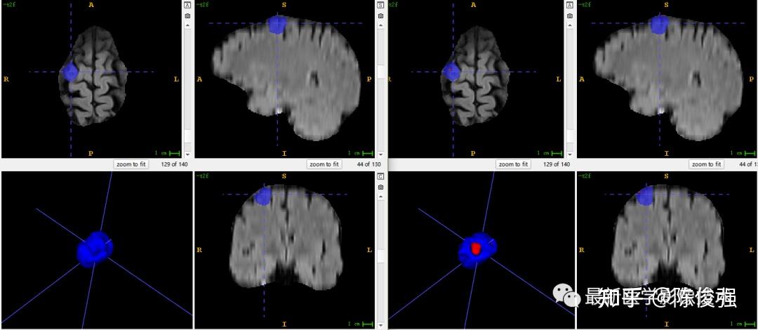BraTS2023-MEN——BraTS2023颅内脑膜瘤分割挑战赛 - 知乎