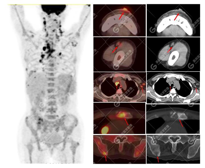 【高尚病例】猫抓病累及淋巴结、骨、皮肤18F-FDG PET/CT 案例分析1例 - 知乎