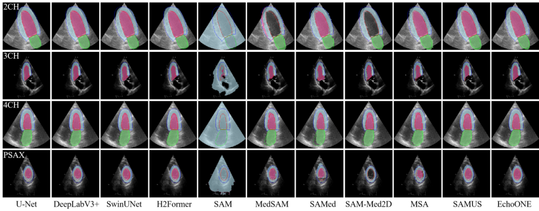 入选CVPR 2025！深圳大学团队等提出EchoONE，可精准分割多切面超声心动图 - 知乎