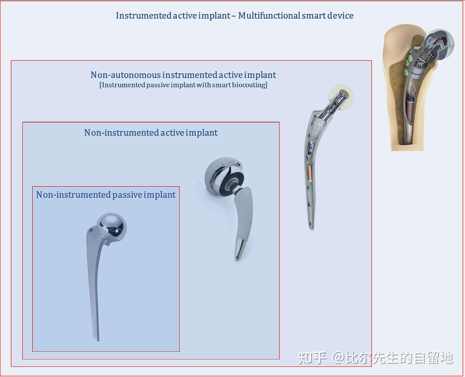 智能植入物：革命性突破与未来展望 - 知乎