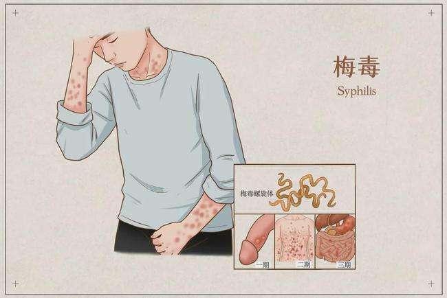 梅毒硬下疳是什么？ 知乎