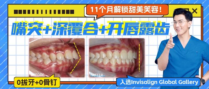入选Invisalign Global Gallery | 嘴突+重度深覆合+开唇露齿，0拔牙+0骨钉11个月解锁甜美笑容！ - 知乎