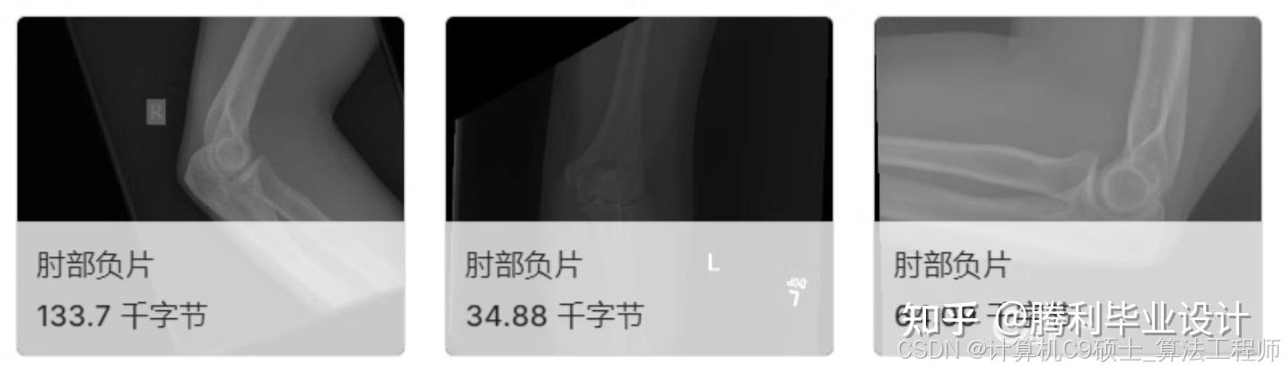 如何使用深度学习框架目标检测yolov8训练骨折检测模型涉及到准备数据集、设置环境、预处理数据、定义模型、训练模型、评估模型性能、分析结果和