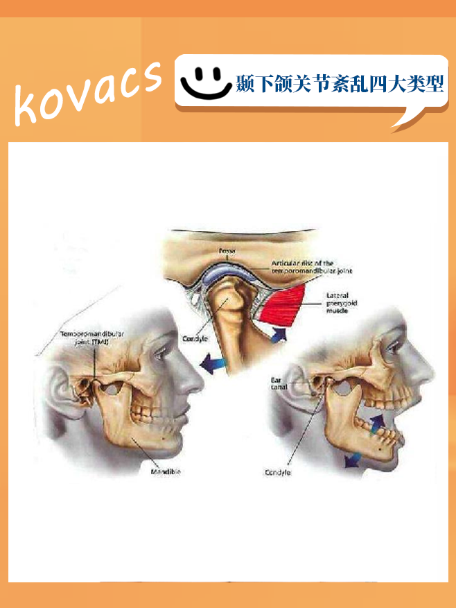 科普答疑|不可复关节盘移位到底是什么？ - 知乎