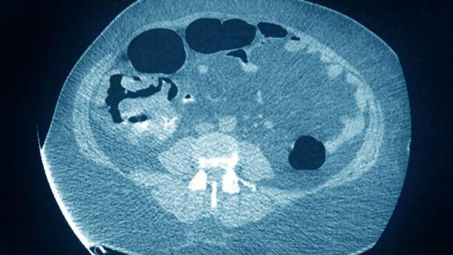 为何越来越多中青年患上结直肠癌？ - 知乎
