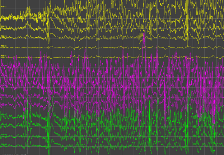 基于CNN的SEEG/EEG脑电数据处理分析 - 知乎