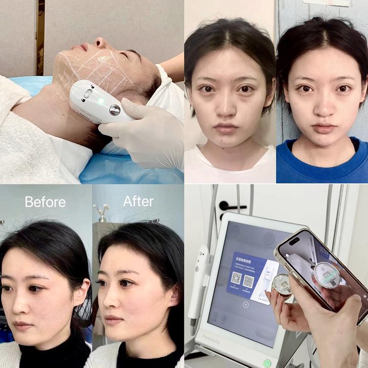 超声炮做完真的有效果吗？超声炮和黄金超声炮有什么区别？如何选择？（治疗效果、价格详情、防伪验真、医生技术等干货一篇通览） 知乎