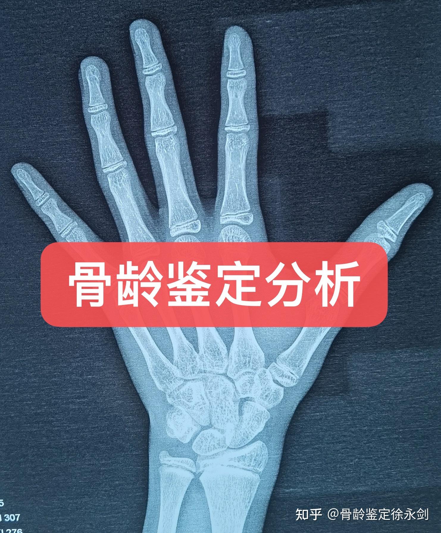 女儿今年11岁，身高162厘米，体重44kg，1月27日的生日，2022年8月来了例假还能长多高啊？ - 知乎