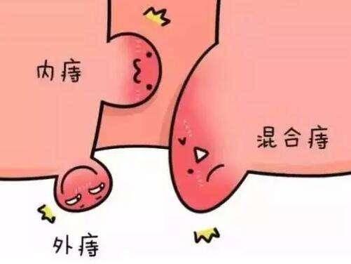 女性更易患痔疮的病因 知乎 2069