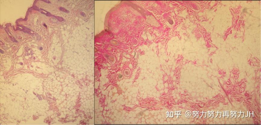 再生型注射针系列4：羟基磷灰石（CaHA） - 知乎