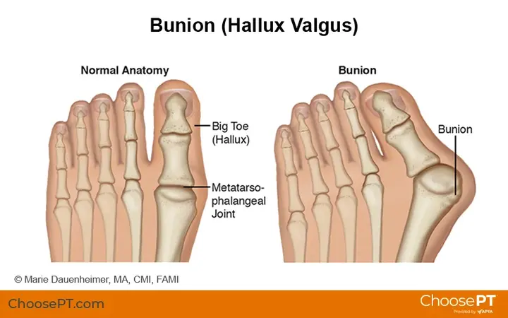 FOP患者大脚趾的发育表型 - 知乎