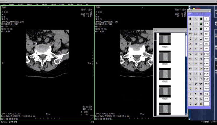支持CT、彩色超声、内窥镜检查的医院影像PACS系统源码（三维重建技术） - 知乎