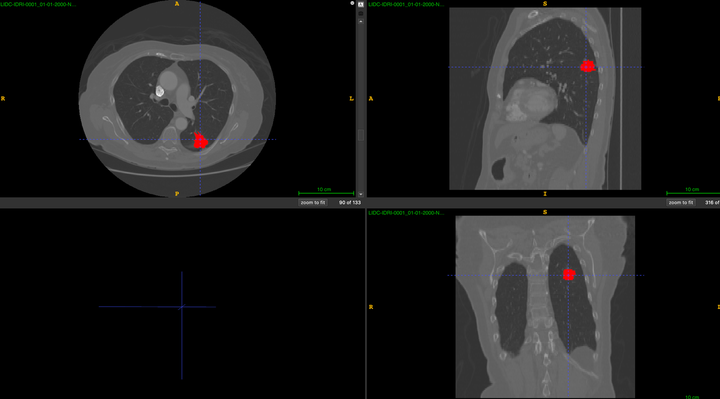 DICOM-LIDC-IDRI-Nodules 数据集介绍 - 知乎