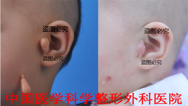 【小耳畸形诊疗指南01】先天性附耳屏-多耳畸形如何治疗？ - 知乎