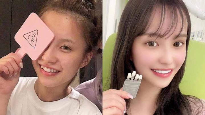 vvsmile 牙齿隐形矫正1年，小姐姐一口乱牙变得整齐又漂亮！ - 知乎