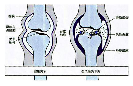大妈每日工作洗碗手指关节疼痛不堪，都是它惹的祸！ - 知乎