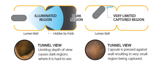 CapsoVision | 胶囊内窥镜系统获得 FDA 批准用于儿科患者 - 知乎