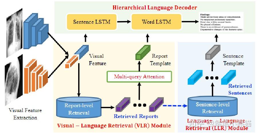 ACL21论文解读:Writing by Memorizing: Hierarchical Retrieval-based Medical Report Generation-根据医学图像自动 ...