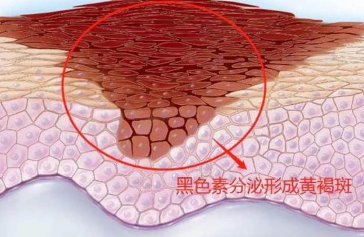 美白原理?美白哪个好? 知乎