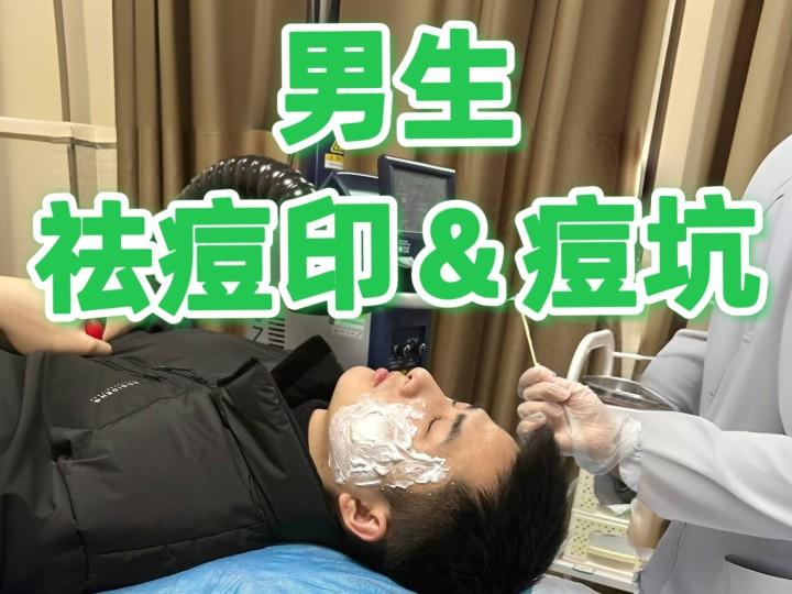 男生脸上爬满痘印and痘坑,怎么办?被男生问了6000遍的『早p晚r』男士祛痘印、痘坑攻略!坚持这4步,痘印、痘坑一键清0! 知乎