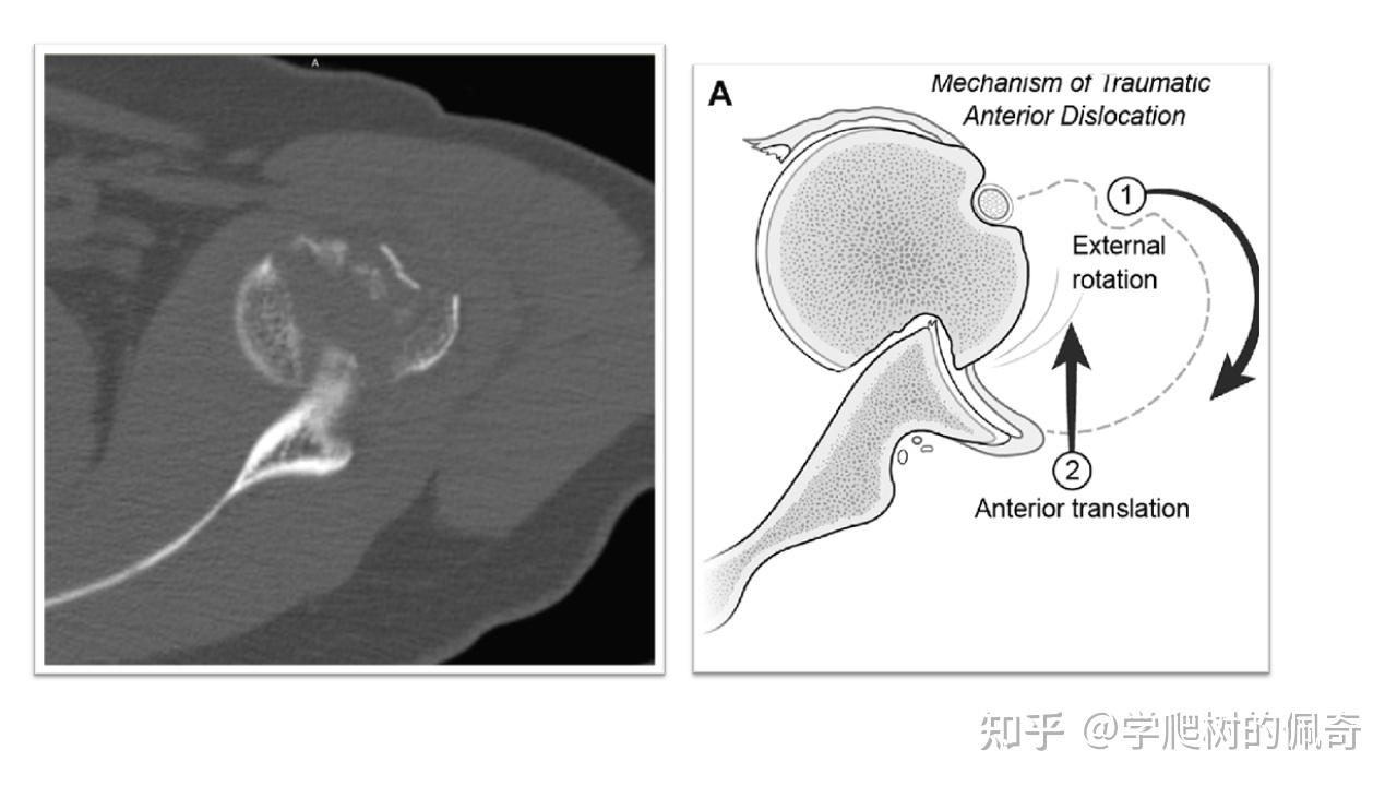 NHANES数据库练手DAY12(酒与骨的研究) - 知乎
