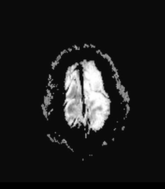 MRI ADC值是怎么来的？咱们来手算一下 - 知乎