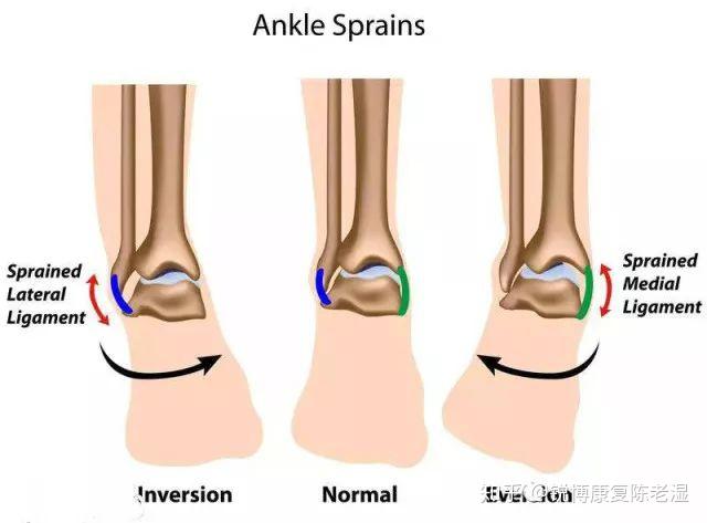什么是慢性踝关节不稳? - 知乎