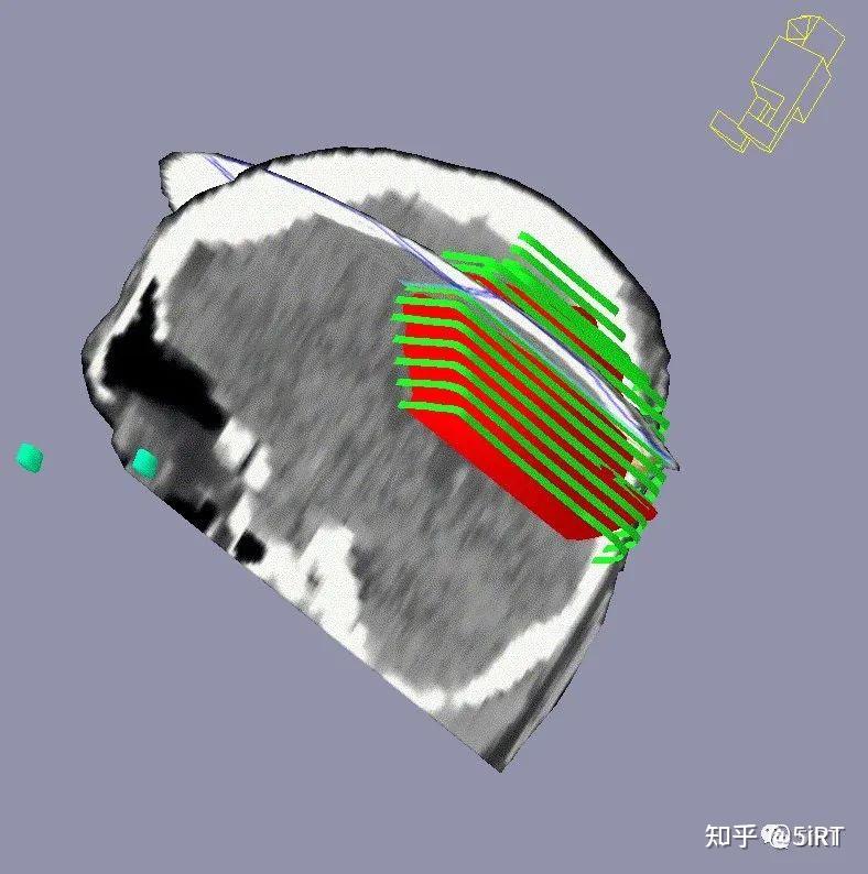 放射治疗计划的RT DOSE和CT图像怎么映射在一层？ - 知乎