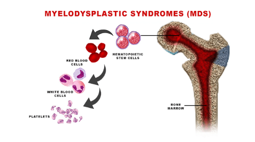 总缓解率91%！新疗法有望破解高危MDS治疗难题 - 知乎