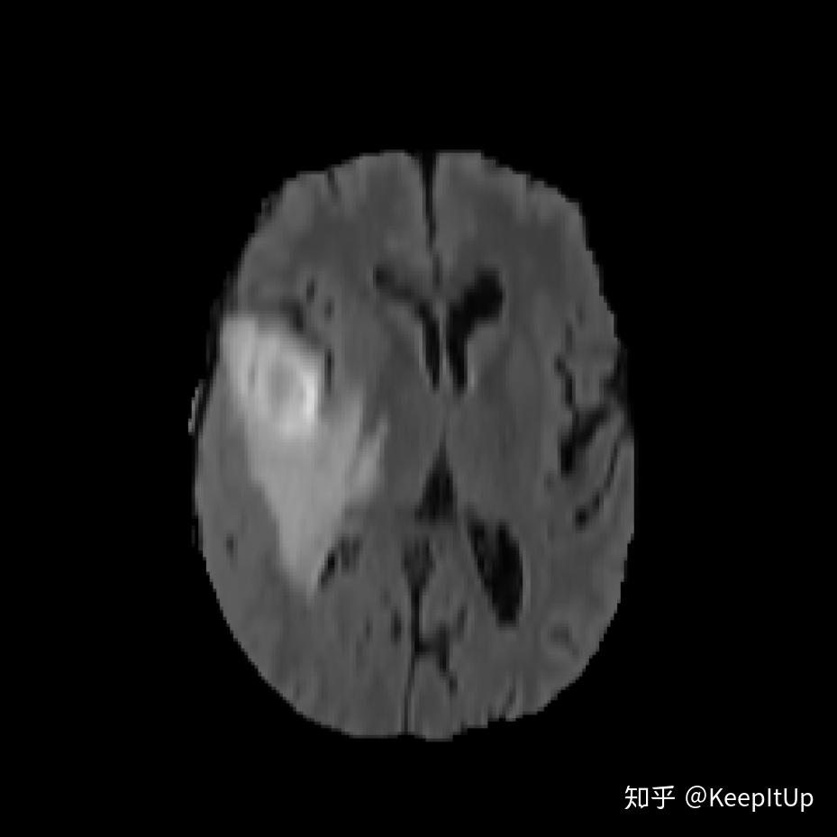 医学影像分割入门、MRI、t1、t2等序列概念 - 知乎