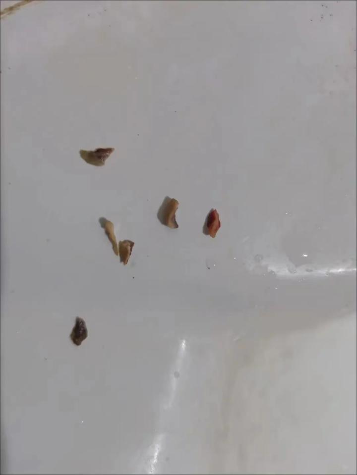 怎么去除牙结石，不用洗牙，刷掉牙结石 知乎