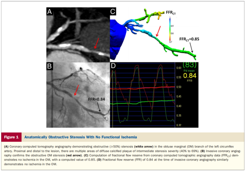 CT-FFR具体是怎么检查的？ - 知乎