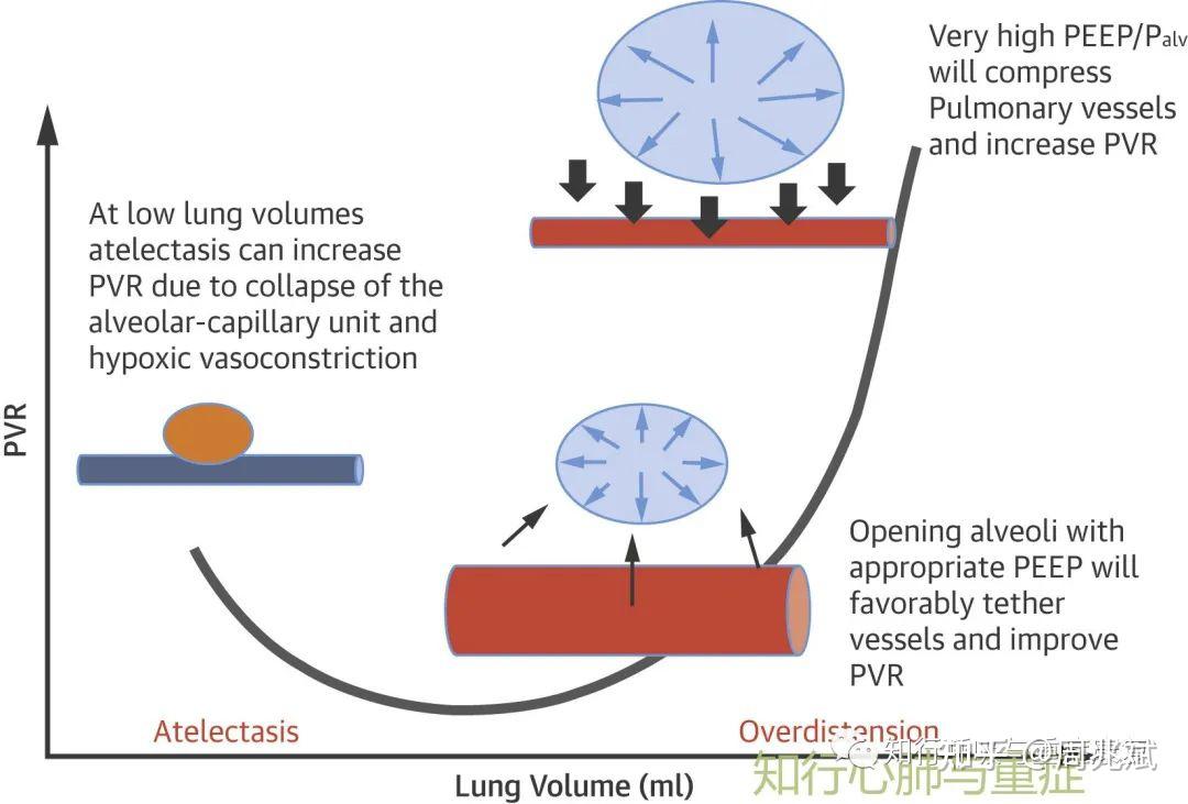 第149期 滴定PEEP的9个方法 - 知乎