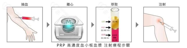 prp美容丨prp注射，prp+脂肪填充面部，prp+自体脂肪隆胸丰臀如何？ - 知乎
